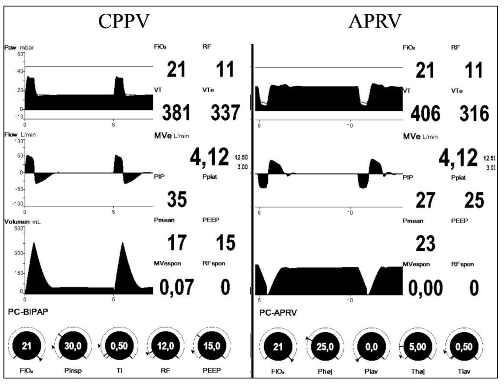Airway Pressure Release Ventilation (APRV) til voksne patienter ...